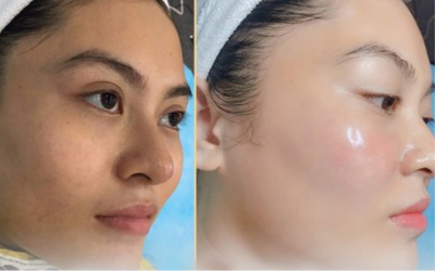 So Sánh Giữa Tiêm Meso Và Tiêm BAP: Phương Pháp Nào Tốt?